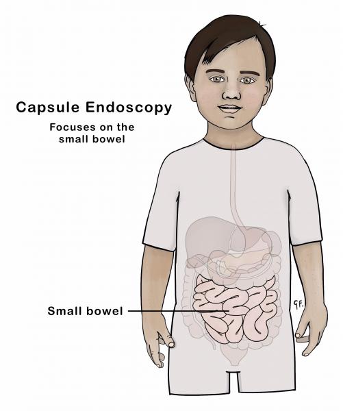 Endoscopy Kidshealth at Richard Harvey blog